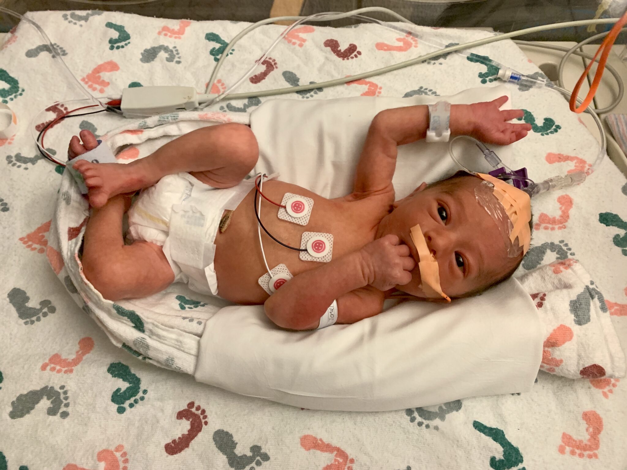 10 Things to Know When Your Baby is Diagnosed with NEC - NEC Society